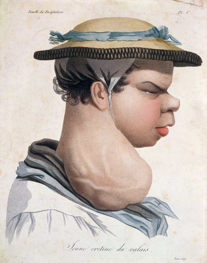 Junger Kretin aus dem Wallis, Illustration aus einem Buch von Baron ...