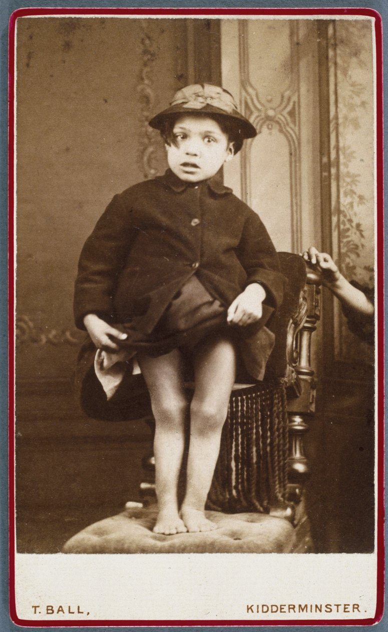 Krankheiten, Rachitis Kind mit Rachitis von Unbekannt